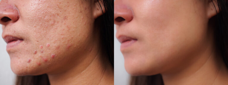 Acne Scarring Treatment In Leeds - The Leeds Clinic