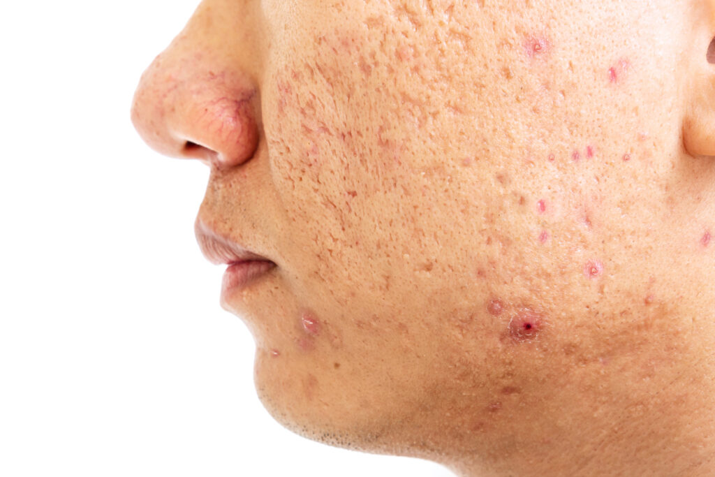 Acne Scarring Treatment In Leeds - The Leeds Clinic