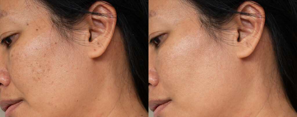 Subcision For Acne Scars Treatment In Leeds - The Leeds Clinic