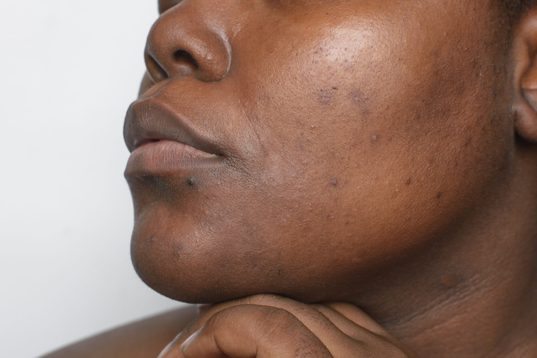 Hyperpigmentation (PIH) Treatment In Leeds - The Leeds Clinic